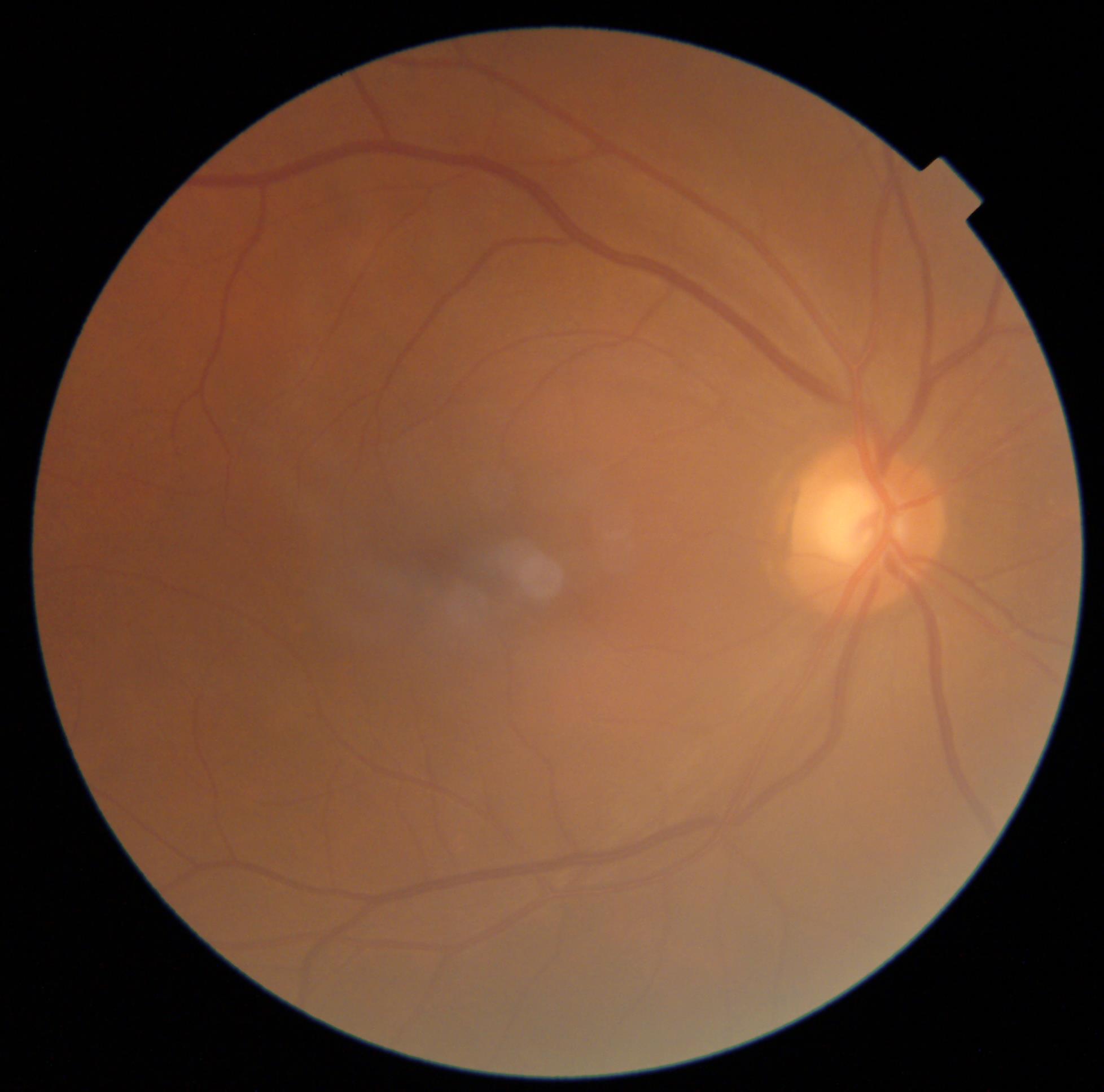 A patient with a cataract in one eye and how he sees.
